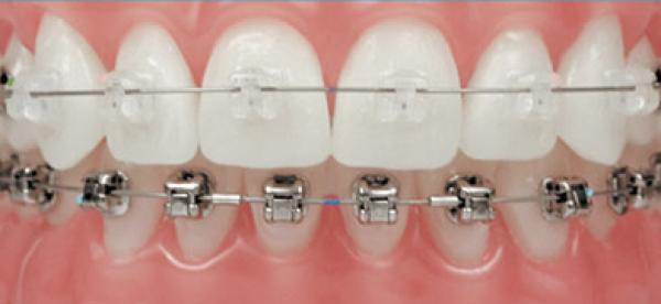 Brackets for Orthodontics: How to choose the most suitable for each ...