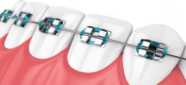 Everything you need to know about Orthodontic Archwires! - Dental ...