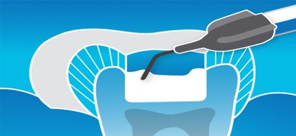 3M Filtek Supreme: Tips for success with flowable composites - Dental ...