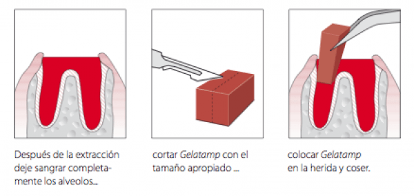 Gelatamp: Dental haemostatic (50 pcs) - ROEKO