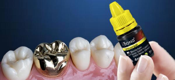 iBond Universal Intraoral Solution for Fractured Restorations - Dental ...