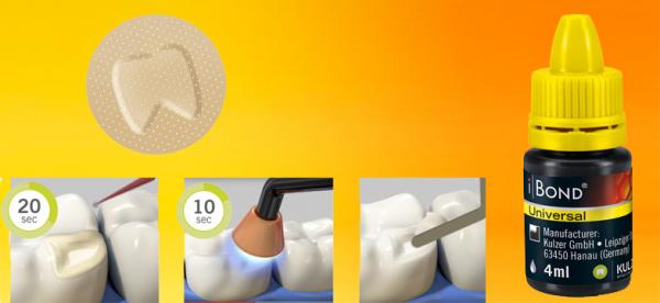 Case of Study: Intraoral repair of ceramic restorations with iBOND ...