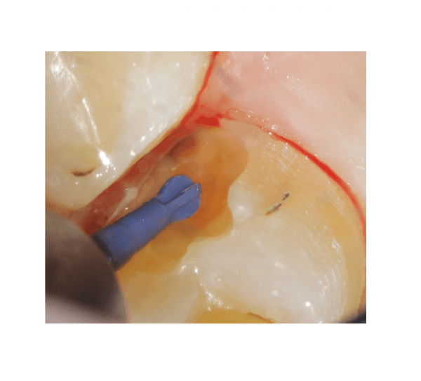 PolyBur P1 polymer bur for CA (10pcs) - KOMET