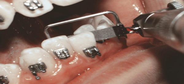 Everything you need to know about Tooth Stripping in one place ...