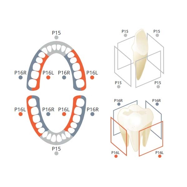 P15, P16R and P16L prophylaxis inserts - MECTRON