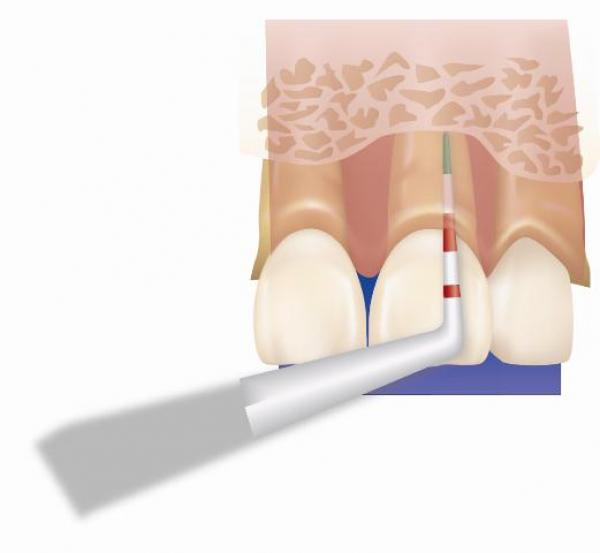 PERIOWISE: Periodontal Probe 6 pieces - PREMIER