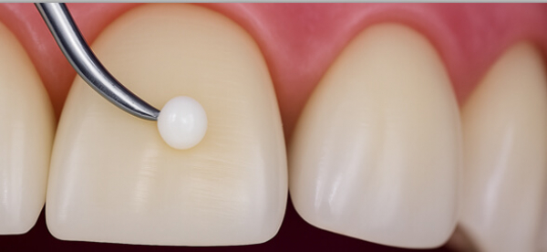 Dental Composites: A Complete Guide to Types, Uses, Benefits, and ...