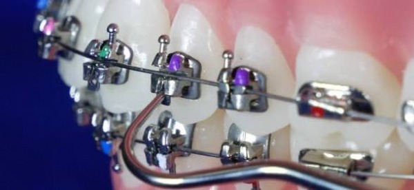 Self-ligating brackets: the importance of friction in orthodontic ...