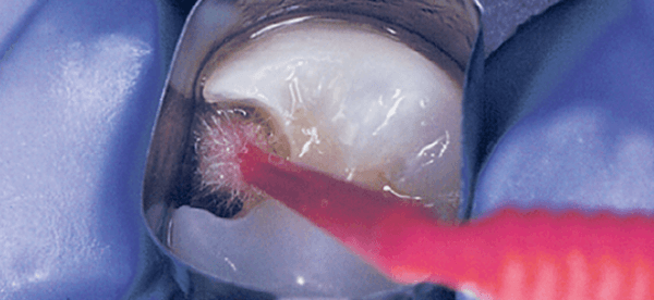 The 7 generations of dental adhesives: A historical journey through its ...