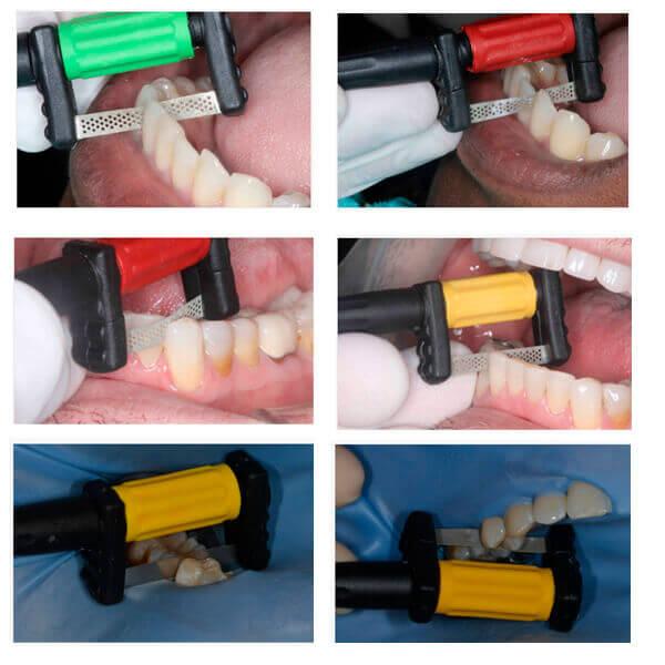 FitStrip: Diamond Strip Kit for IPR - GARRISON