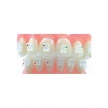 Sapphire brackets - Dental Supplies and Equipment - Dentaltix