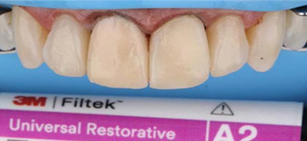Conoce la gama de composites Filtek de 3M para tus restauraciones ...