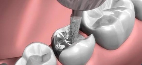 La aleación de amalgama dental en la actualidad: actualiza tus ...