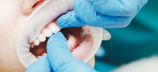 Todo lo que debes saber sobre cementos dentales (III): Cemento de ...