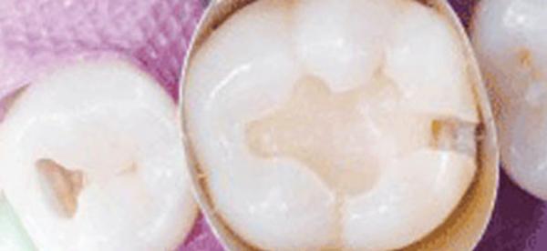 Tout ce que vous devez savoir sur les ciments dentaires (IV) : Ciment ...