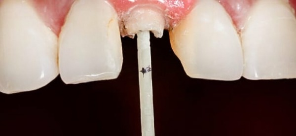 Tout ce que vous devez savoir sur les tenons en fibre de verre et la ...