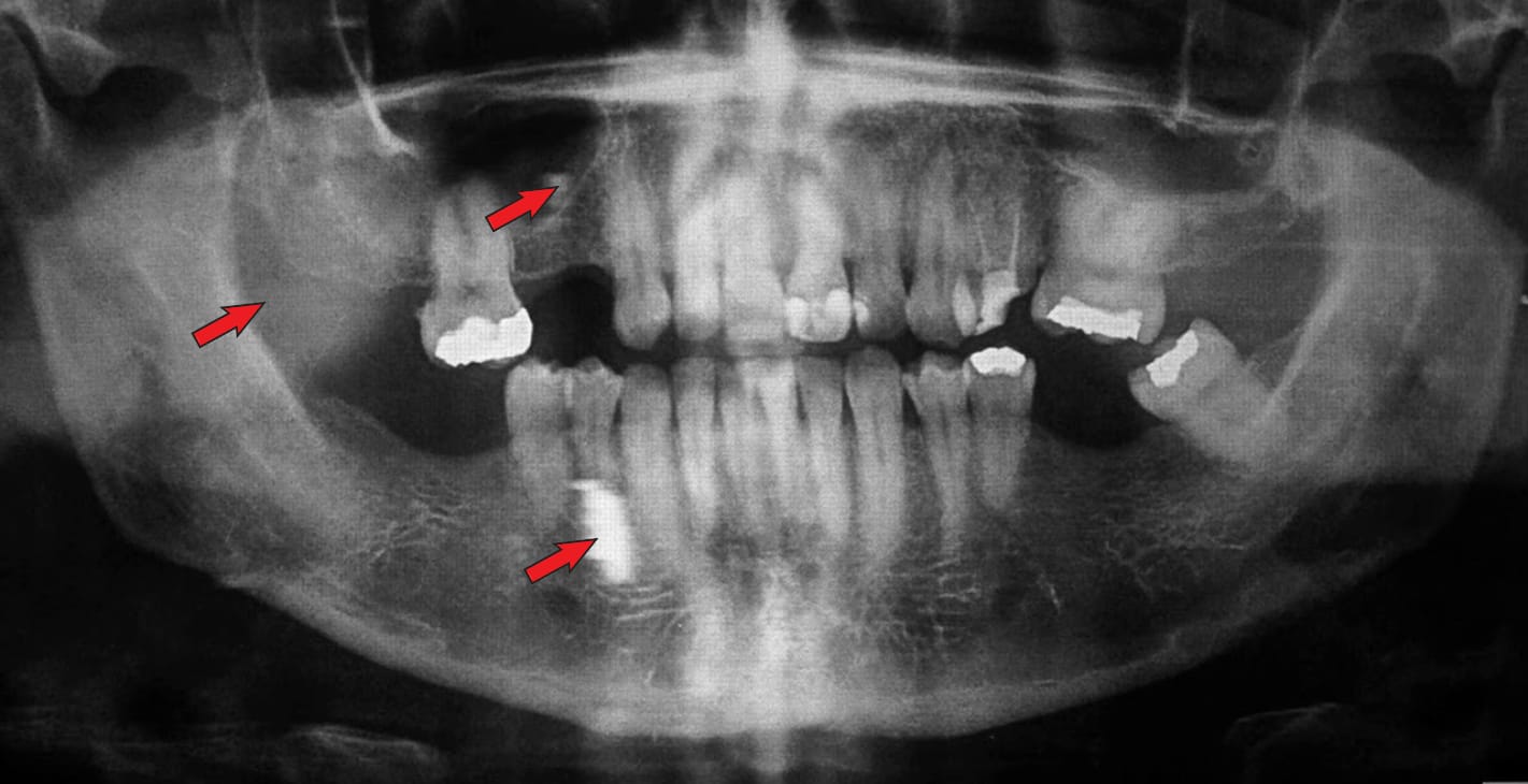 Ortopantomografia (OPG) o radiografia panoramica. Quali errori evitare per ottenere un'immagine ...