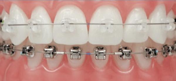 Brackets Ortodontici: Come scegliere il più adeguato per ciascun ...