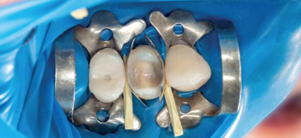 Isolamento dentale: obiettivi e applicazioni in odontoiatria ...