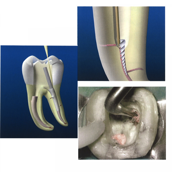 Punta da ultrasuoni Pro Ultra Endo (1U). - DENTSPLY