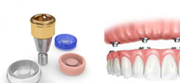 Pilares Locator para implantes: tudo o que você precisa saber. - Dentaltix