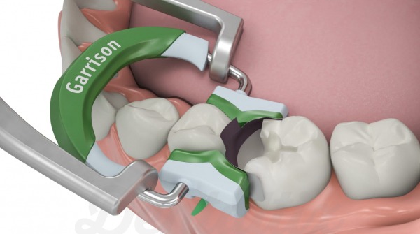 O guia definitivo das matrizes dentárias: escolha a melhor para cada ...
